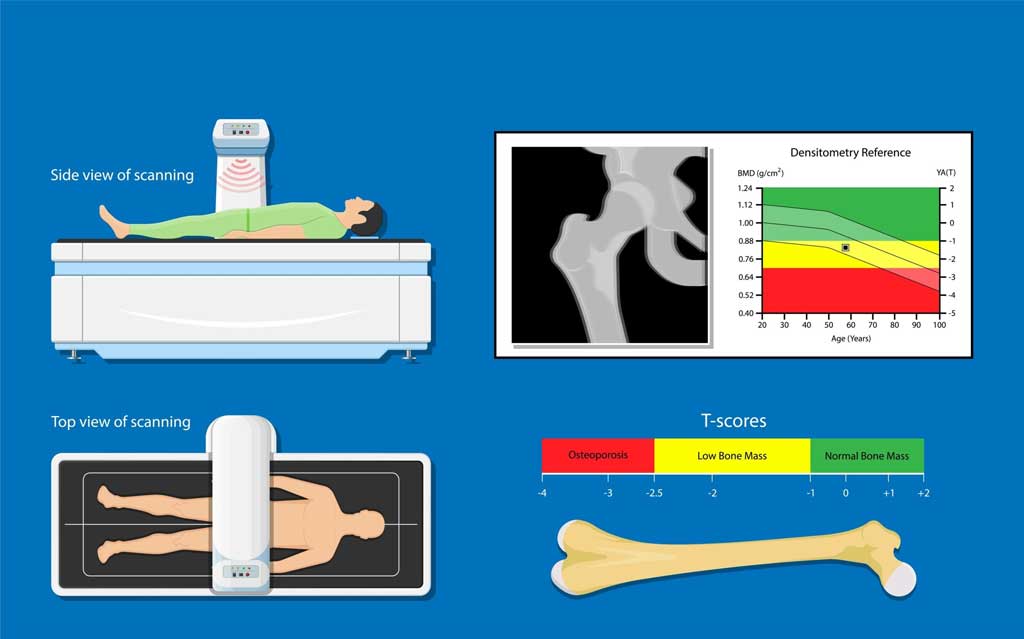 What Is A Bone Density Scan Hill Regional Hospital What Is A Bone Density Scan Hill Regional Hospital